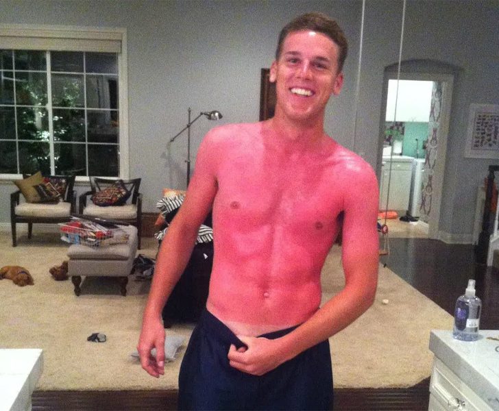 These Are The Most Ridiculous Sunburns You Will Ever See! - Page 3 of ...